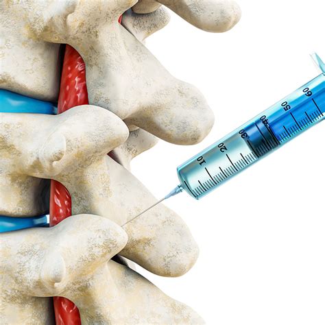 Midline Epidural Steroid Injection Lumbar Sacral Interlaminal Esi Genesis