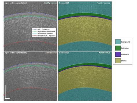 corneanet automatically segments cornea oct images with high accuracy