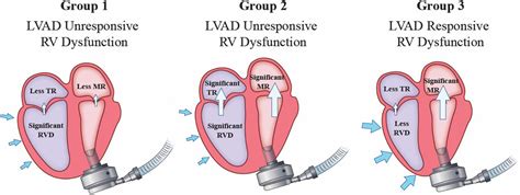 lvad