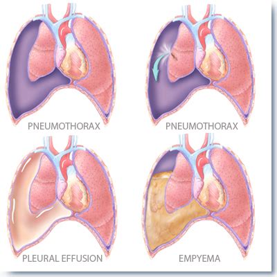 Medical For Us Difference Between Emphysema And Emphyema