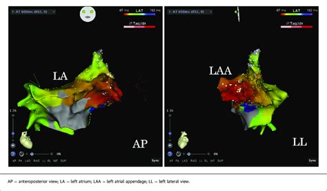 Electroanatomical Activation Map Download Scientific Diagram