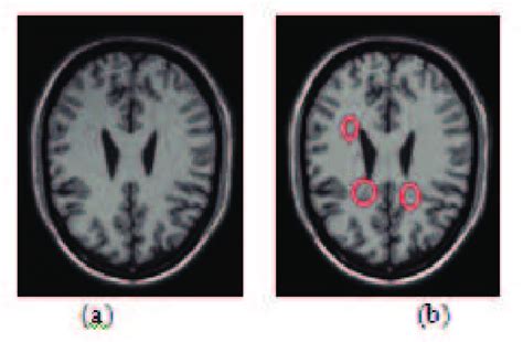 Example Of A Normal A And A Multiple Sclerosis B Brainweb Simulated