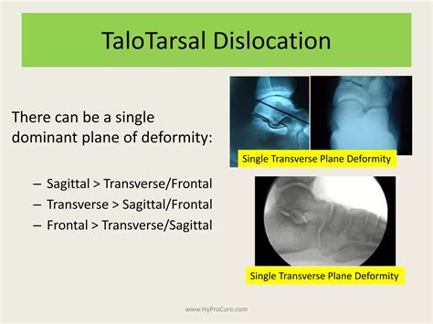 Talotarsal Dislocation Radiographic Evidence Pptx