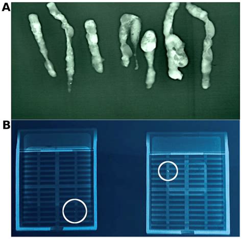 Breast Microcalcifications Past Present And Future Review Pmc