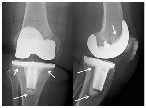 Pmma Based Bone Cements And The Problem Of Joint Arthroplasty