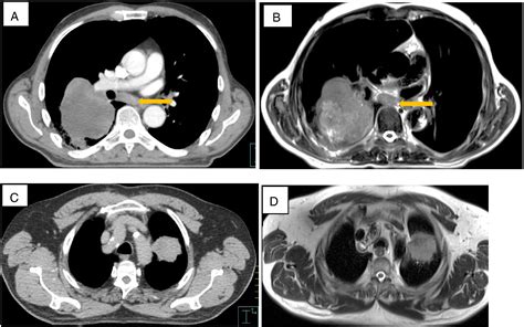 Mri In Radiotherapy For Lung Cancer A Free Breathing Protocol At 3t