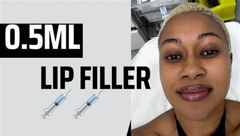 How Long Does 0 5 Ml Lip Filler Last