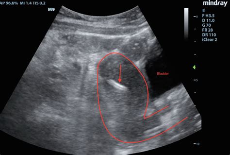 Hennepin Ultrasound Pain After Iud Placement