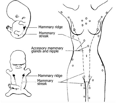 Ectopic Breast Tissue Has Been Previously Reported In Various Locations Download Scientific