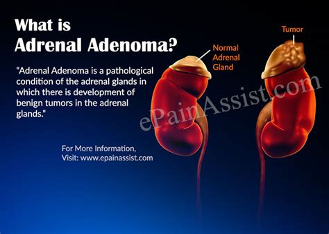 What Is Adrenal Adenoma And How Is It Treated
