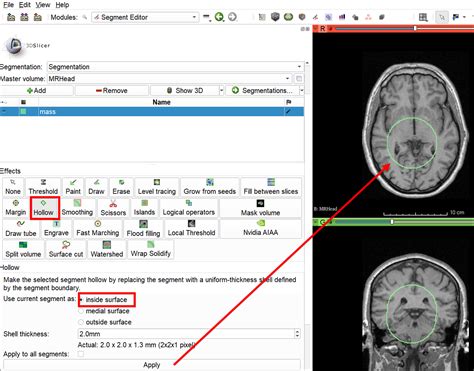 瘤周组织怎么勾画 2，来自 Caoyufu 问题求助 3dslicer中文论坛