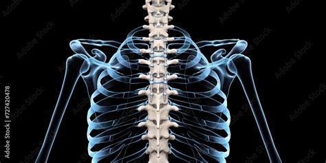 3d Medical Illustration Of Posterior Thoracic Fusion With Pedicle