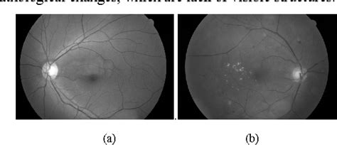 Figure 1 From The Retinal Image Mosaic Based On Invariant Feature And Hierarchial Transformation