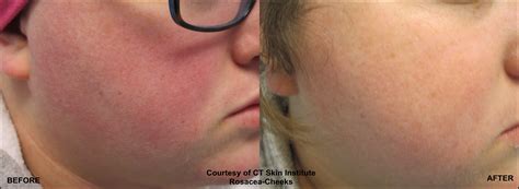 Rosacea Treatments From The Connecticut Skin Institute