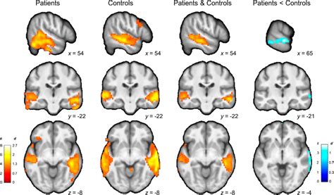 Schizophrenia Auditory Hallucinations