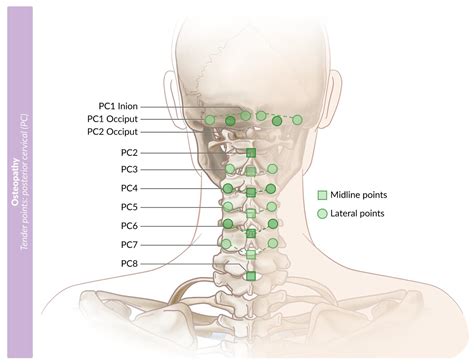 Posterior Trigger Points Neck