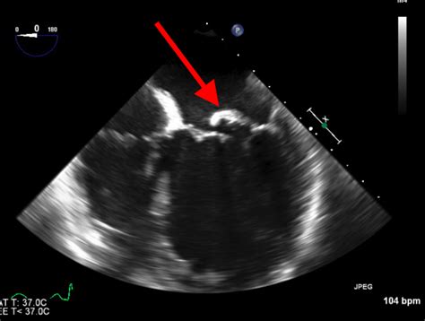 Infective Endocarditis Mitral Valve