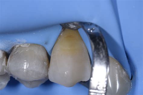 Absolute Isolation For Class V Restorations