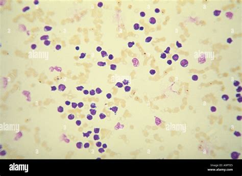 Acute Myeloid Leukemia Hi Res Stock Photography And Images Alamy