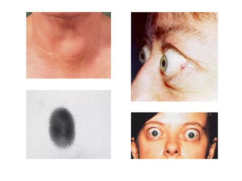 Thyroid Gland Dysfunction Ppt