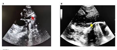 Figure 1 From The Relationship Between The Picc Tip Position And Weight Gain Length Growth Of
