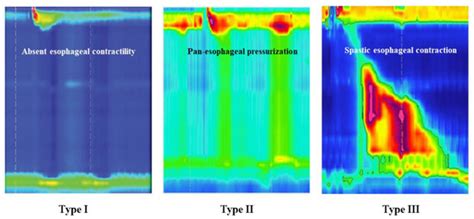 Diagnosis And Management Of Achalasia Updates Of The Last Two Years