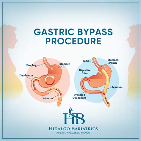Breakthrough Weight Loss Gastric Bypass Surgery In Puerto Vallarta 1