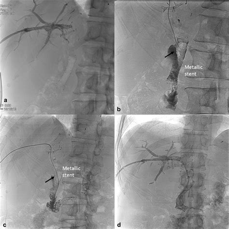 Targeted Metallic Stent In A 56 Year Old Man A Cholangiogram