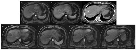 Combination Therapy Of Bland Transarterial Embolization And Microwave Ablation For