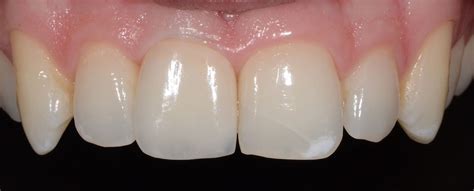 Single Missing Front Tooth Cardiff DentalImplantsWales