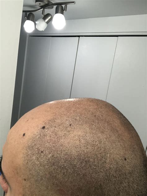 Severe Dryness Redness And Hyperpigmentation Rbald