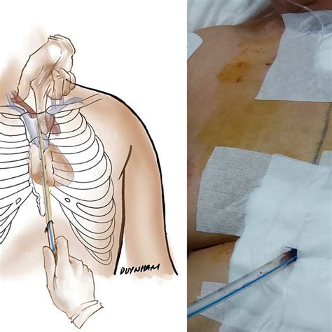 Chest X Ray Taken Before And After Insertion Of The Drainage Tube Left
