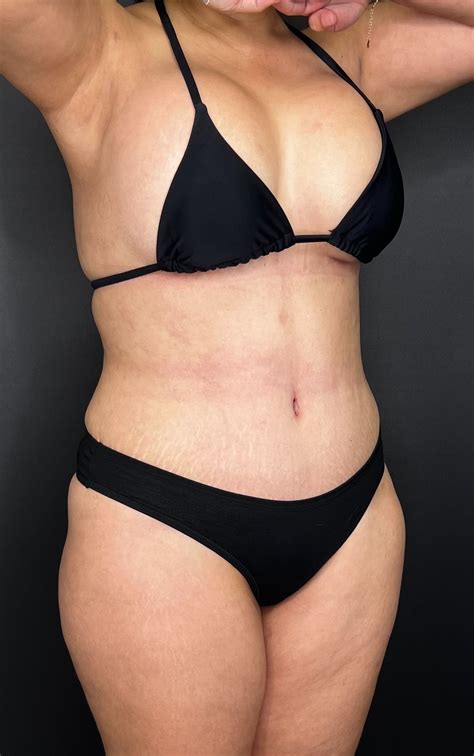 Abdominoplasty Mafi Md Board Certified Plastic Surgeon In Fresno Ca