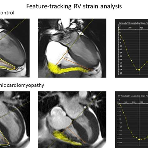 example of cardiovascular magnetic resonance cmr feature tracking