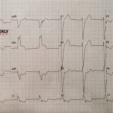 Barcelona Criteria Ecg Weekly