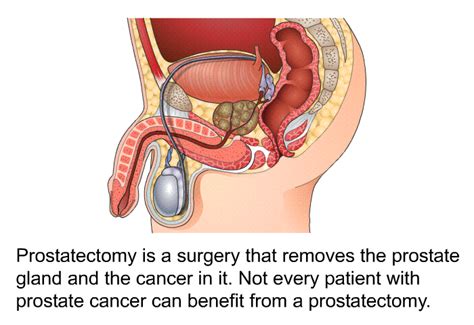 Prostatectomy