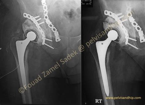 Case 9 Hip Professor Fouad Zamel Sadek