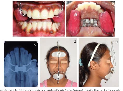 Figure 3 From Management Of Skeletal Cl Iii Malocclusion Using Simultaneous Alternate Rapid