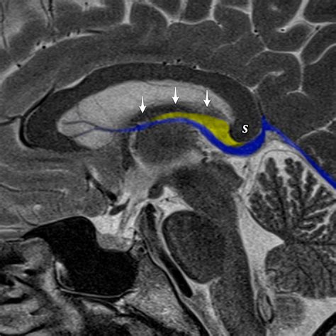 Velum Interpositum Cyst Mri At Charlotte Stretton Blog