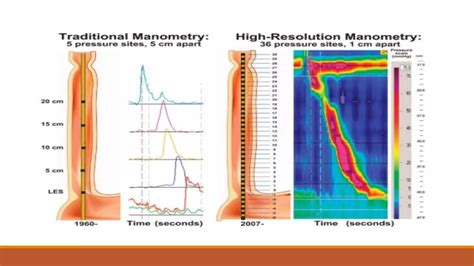Esophageal Motility Disorders Pptx