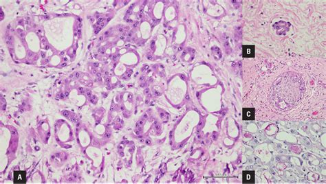 Figure 1 From Primary Apocrine Adenocarcinoma Of The Orbit With