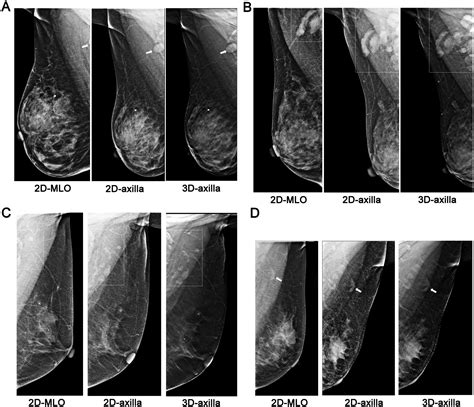 Axilla View Of Mammography In Preoperative Axillary Lymph Node