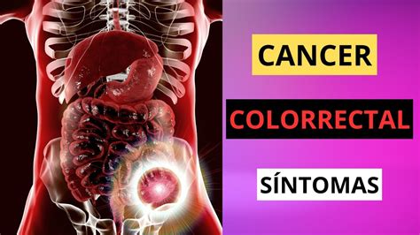 ¡sÍntomas Que Alertan De CÁncer Colorrectal Youtube