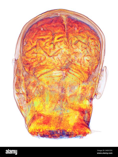 Human Head And Brain Coloured 3d Magnetic Resonance Imaging Mri Scan