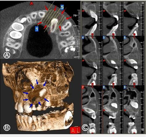 Cone Beam Computed Tomography Cbct Images From The First Surgical Download Scientific Diagram
