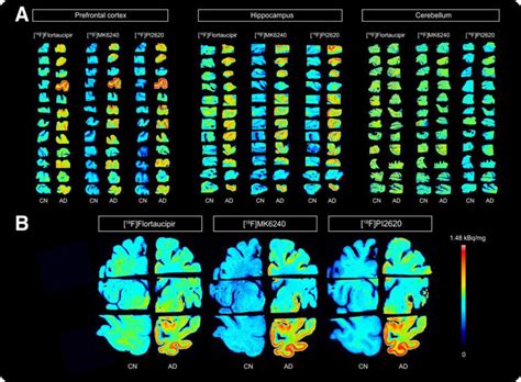 Next Generation Tau Radiotracers Outperform Fda Approved Imaging Agents In Detecting Alzheimers