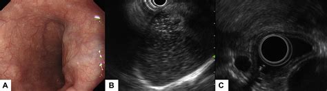 Endoscopic Fenestration With Eus Guidance For Esophageal Duplication