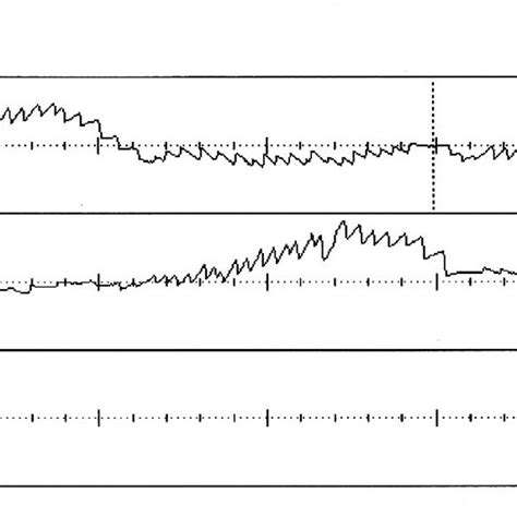 The Results Of Oculomotor Testing It Shows Saccadic Top And Pursuit
