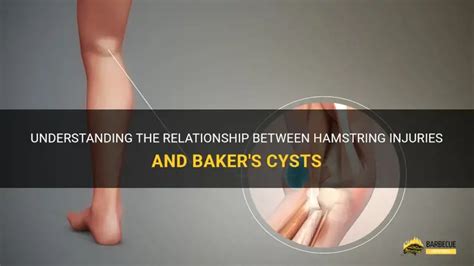 Understanding The Relationship Between Hamstring Injuries And Bakers Cysts Shungrill