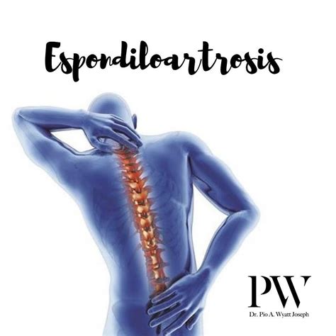 La Espondiloartrosis O Artrosis De La Columna Vertebral Es Una